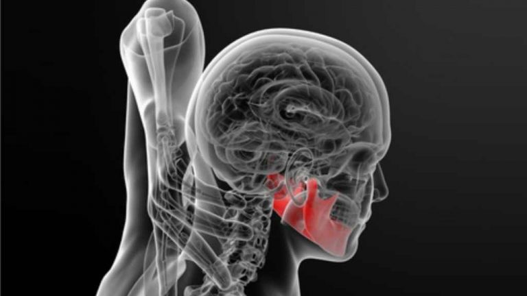 TMJ Neck Pain Noblesville | Deldar Dental | TMJ Dentist